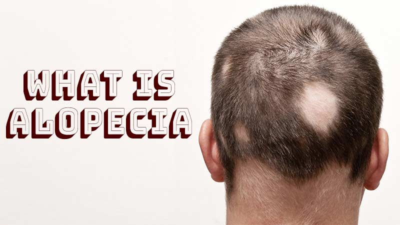 What Is Alopecia? Have You Got There The Right Way? - Layla Hair ...
