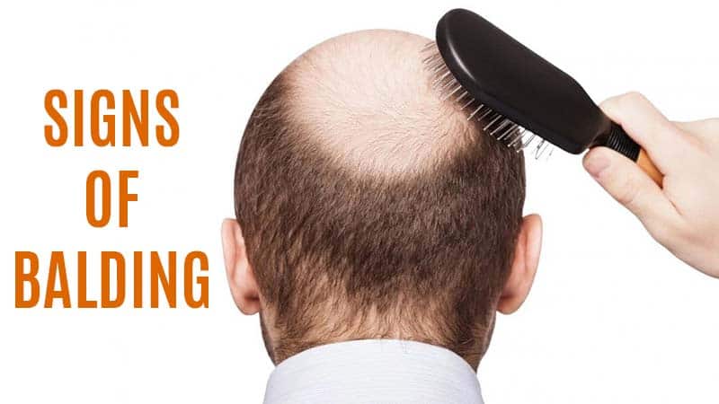 Signs Of Balding - Pay Attention To These Signals!
